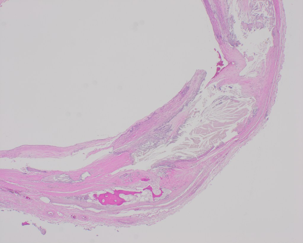 Atherosclerosis | The Autopsy Book