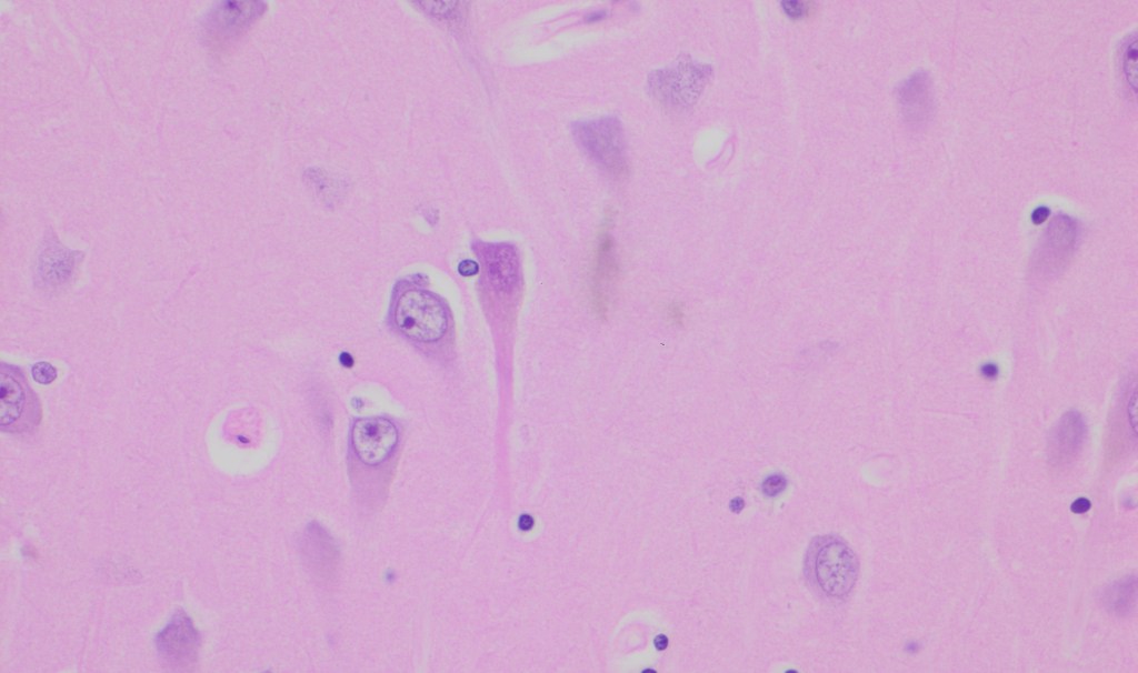 Global CNS Ischemia (Hypoxic Ischemic Encephalopathy) | The Autopsy Book