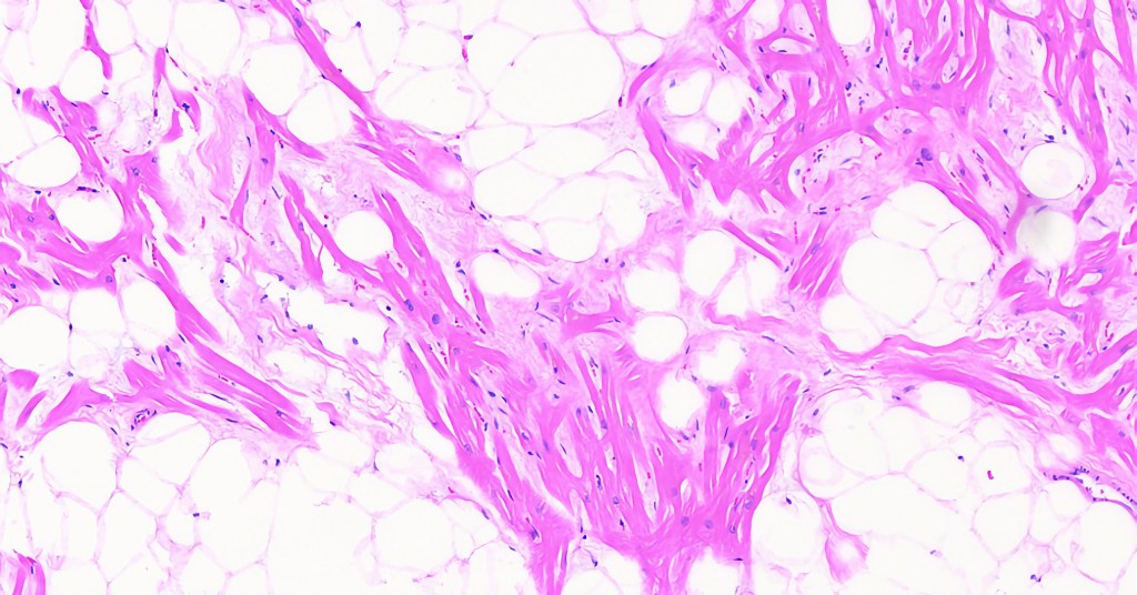 Arrythmogenic Right Ventricular Cardiomyopathy | The Autopsy Book