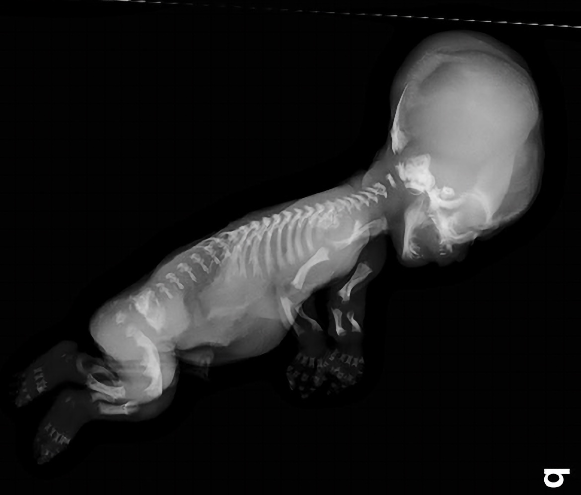 Fetal Autopsy: Measurement and Weights | The Autopsy Book
